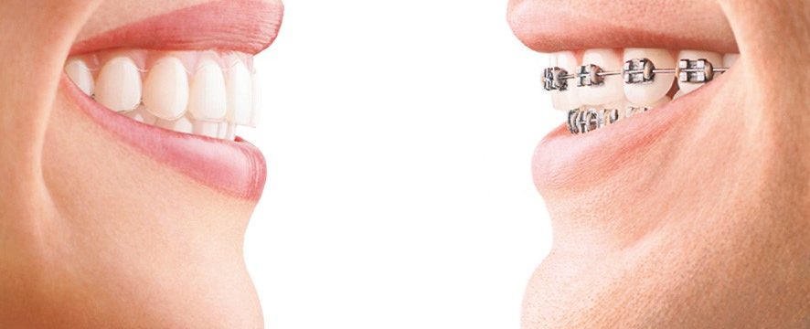 9 Top Benefits Of Having Dental Braces